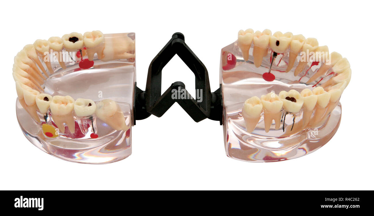 Orthodontic teeth model Stock Photo - Alamy
