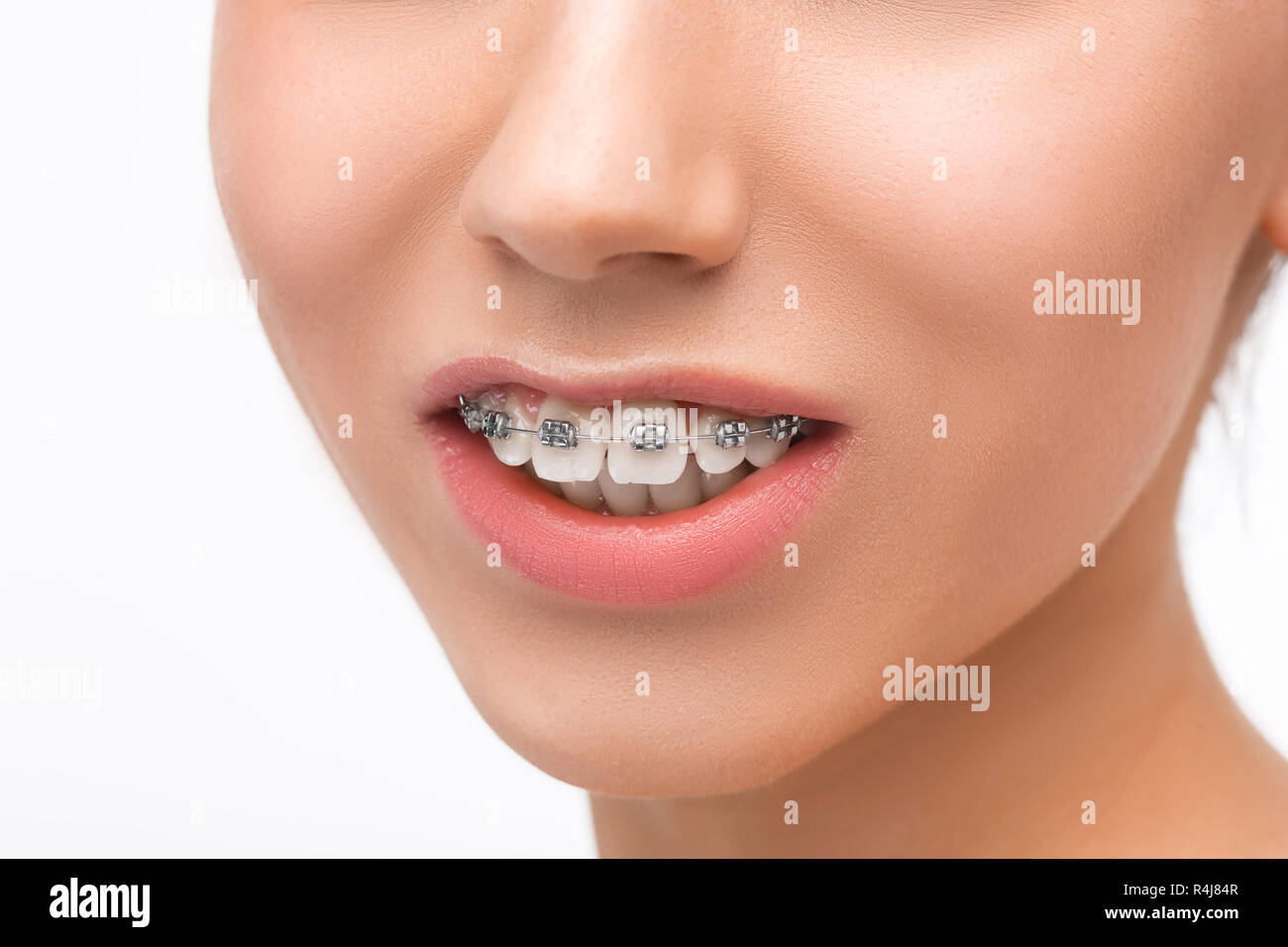Beautiful young woman with teeth braces Stock Photo - Alamy