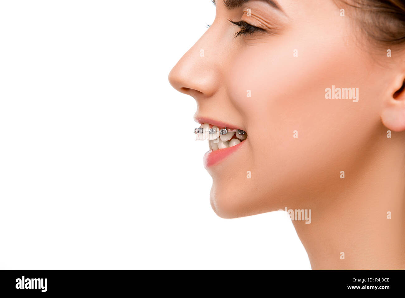 Beautiful young woman with teeth braces Stock Photo - Alamy