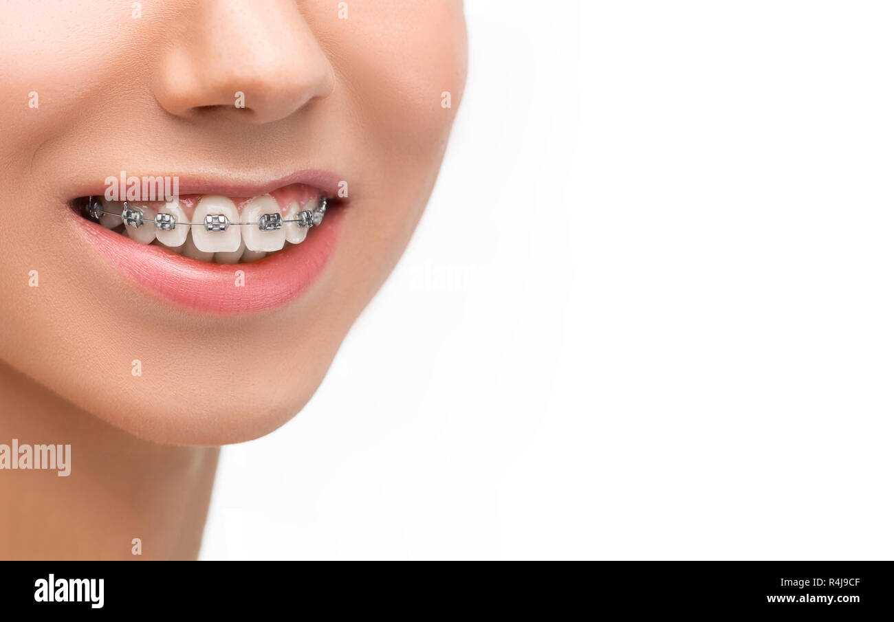 Beautiful young woman with teeth braces Stock Photo - Alamy