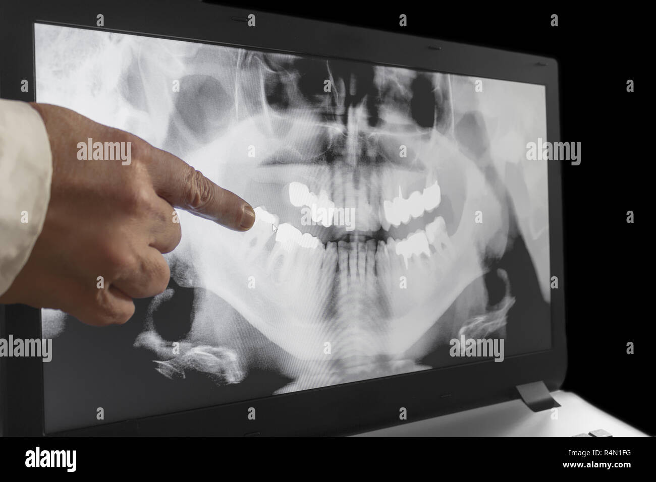 Hand holding dental x ray teeth hi-res stock photography and images - Alamy