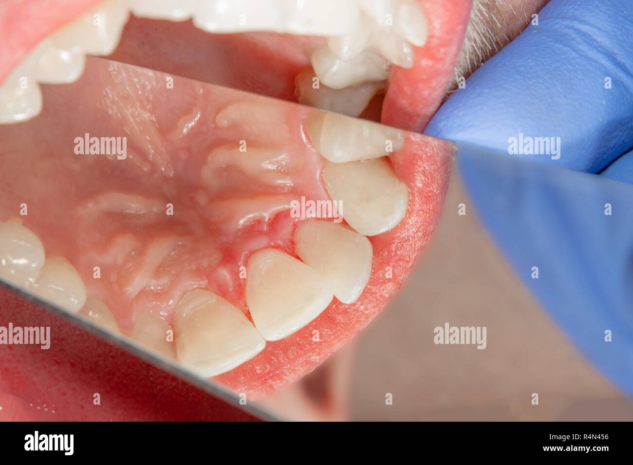 tooth smile close up. The concept of healthy proper oral hygiene Stock ...