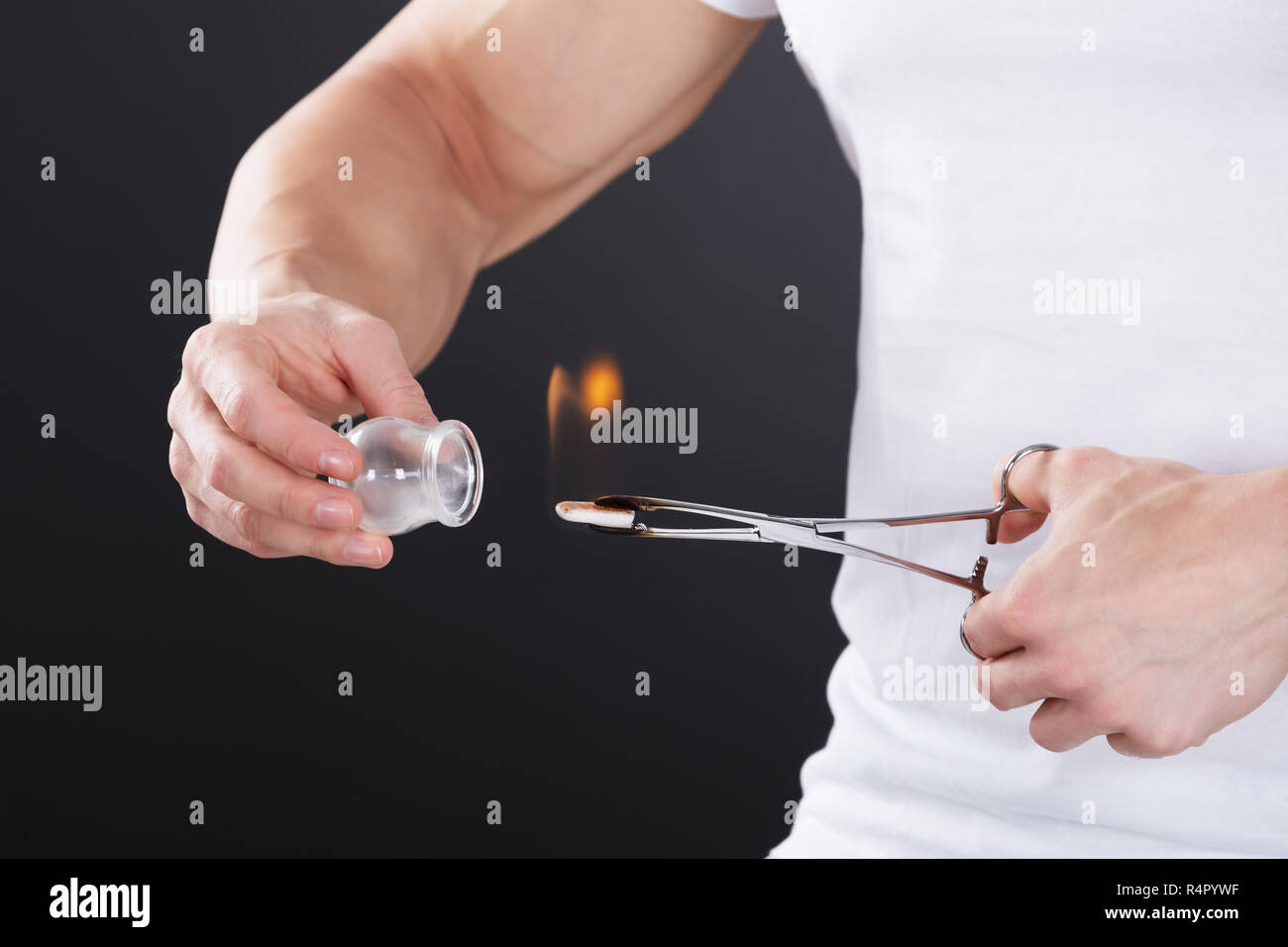Therapist Giving Cupping Therapy Stock Photo - Alamy