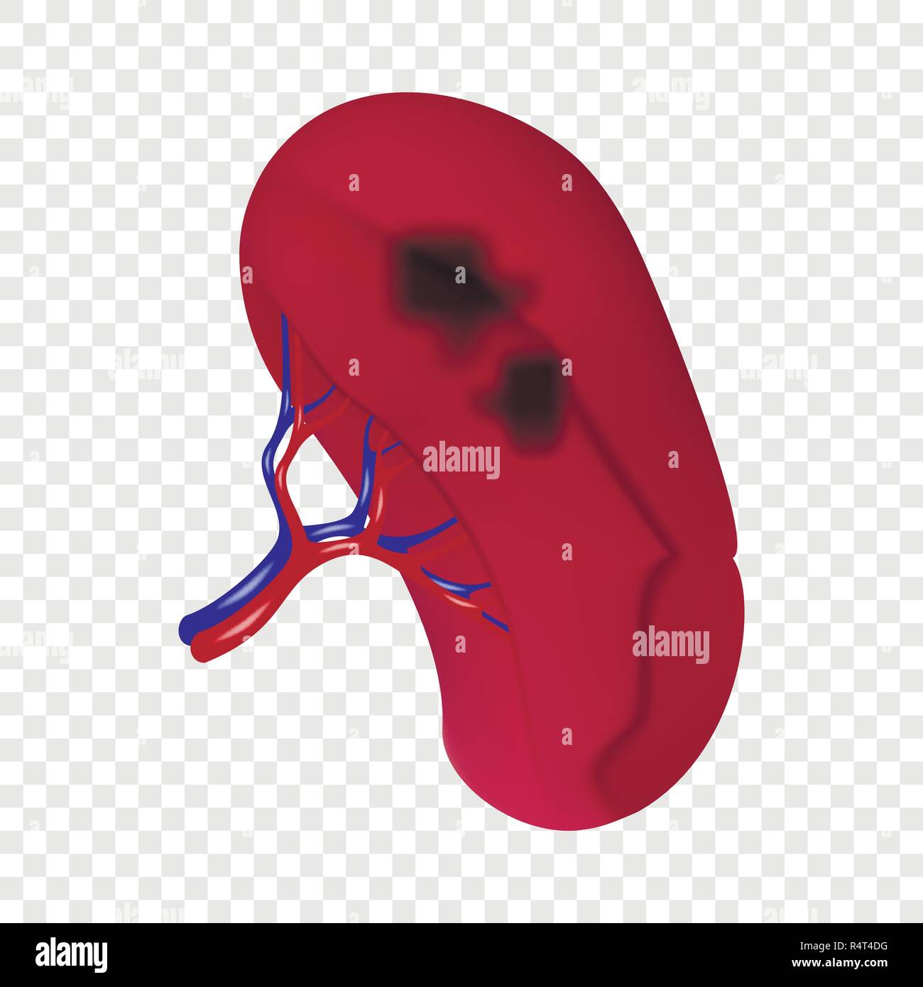 Black disease of spleen icon. Realistic illustration of black disease ...