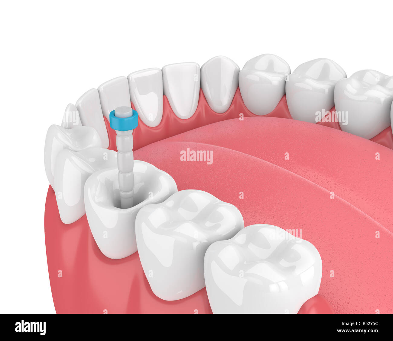 3d render of jaw with teeth and fiber post over white. Endodontic ...