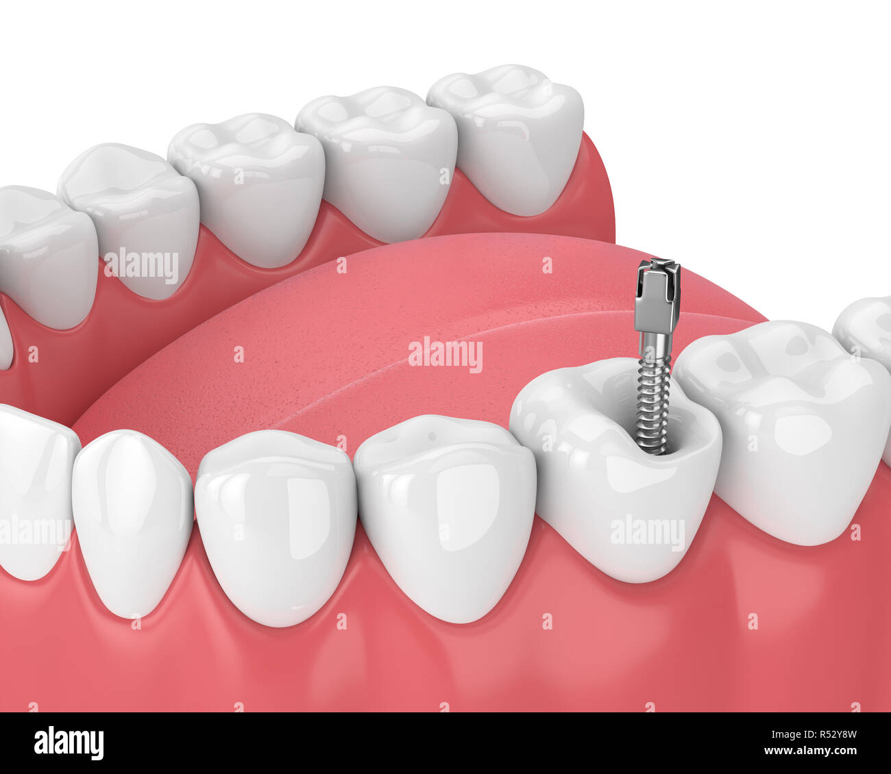 Dental Metal Post