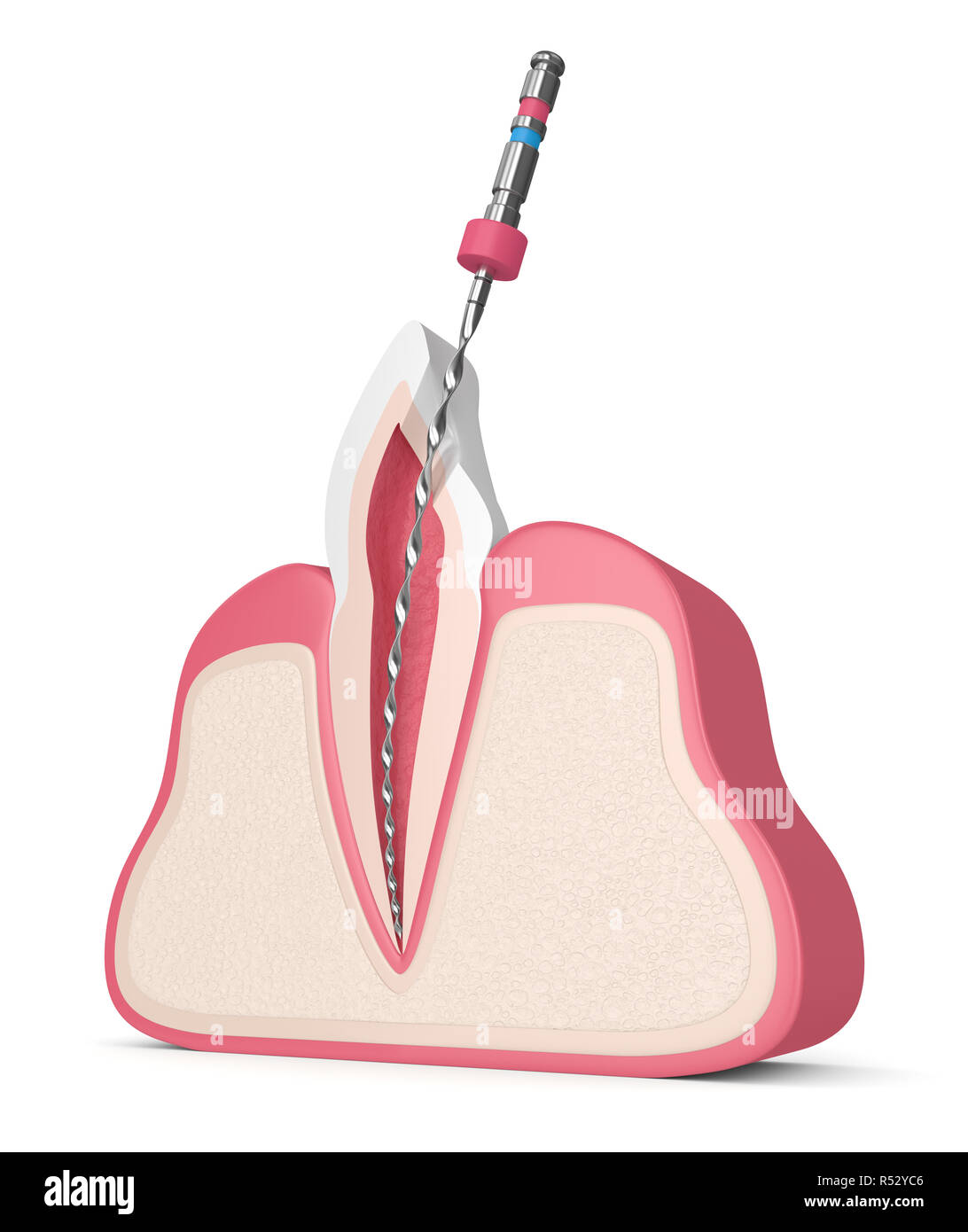 3d render of tooth with endodontic file in gums. Root canal treatment ...