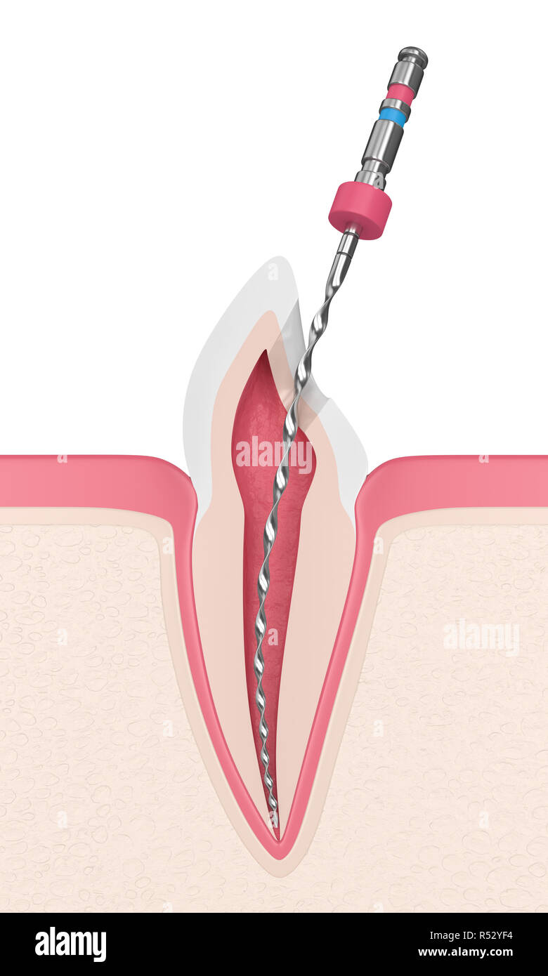 3d render of tooth with endodontic file in gums. Root canal treatment ...