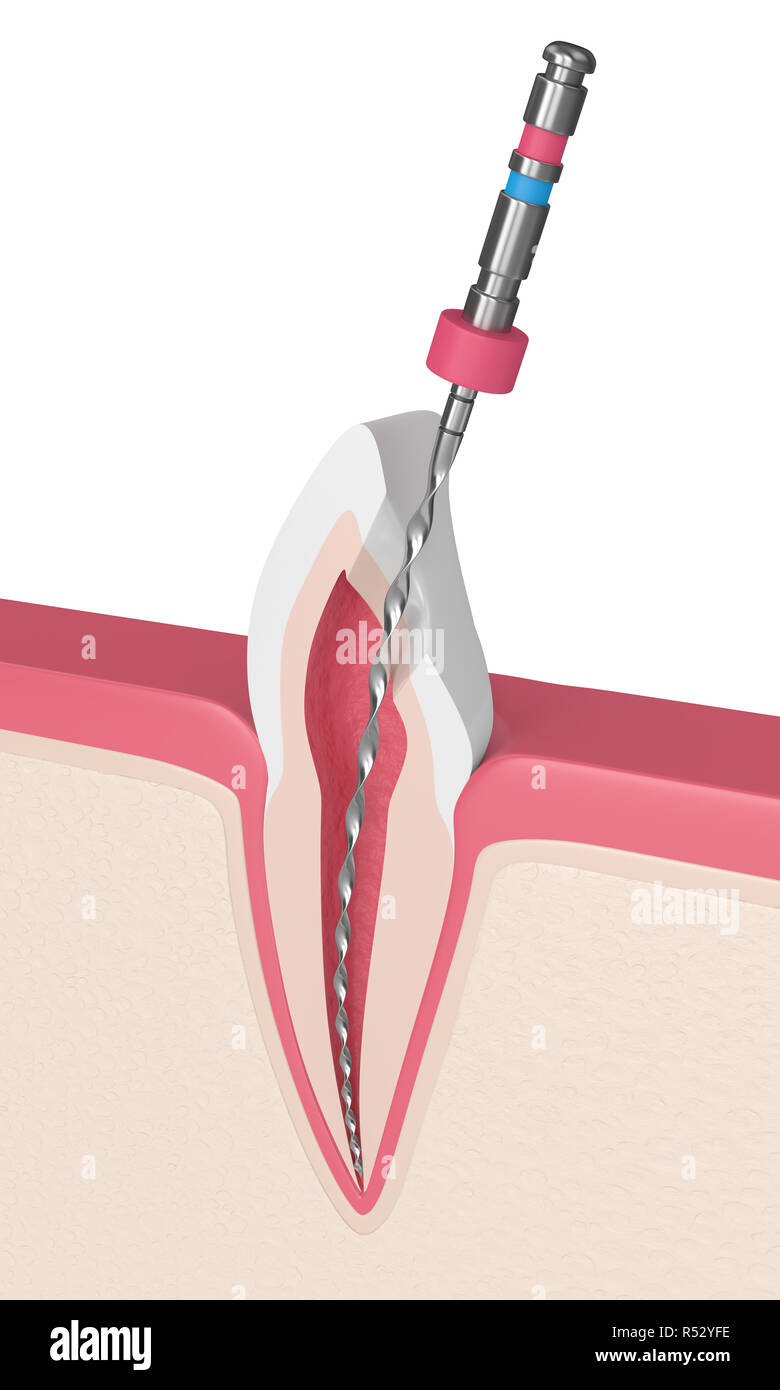 3d render of tooth with endodontic file in gums. Root canal treatment ...