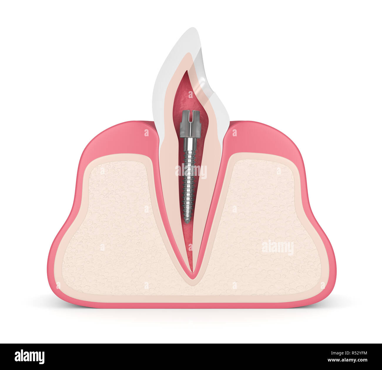 3d render of tooth with dental metal post over white. Endodontic ...