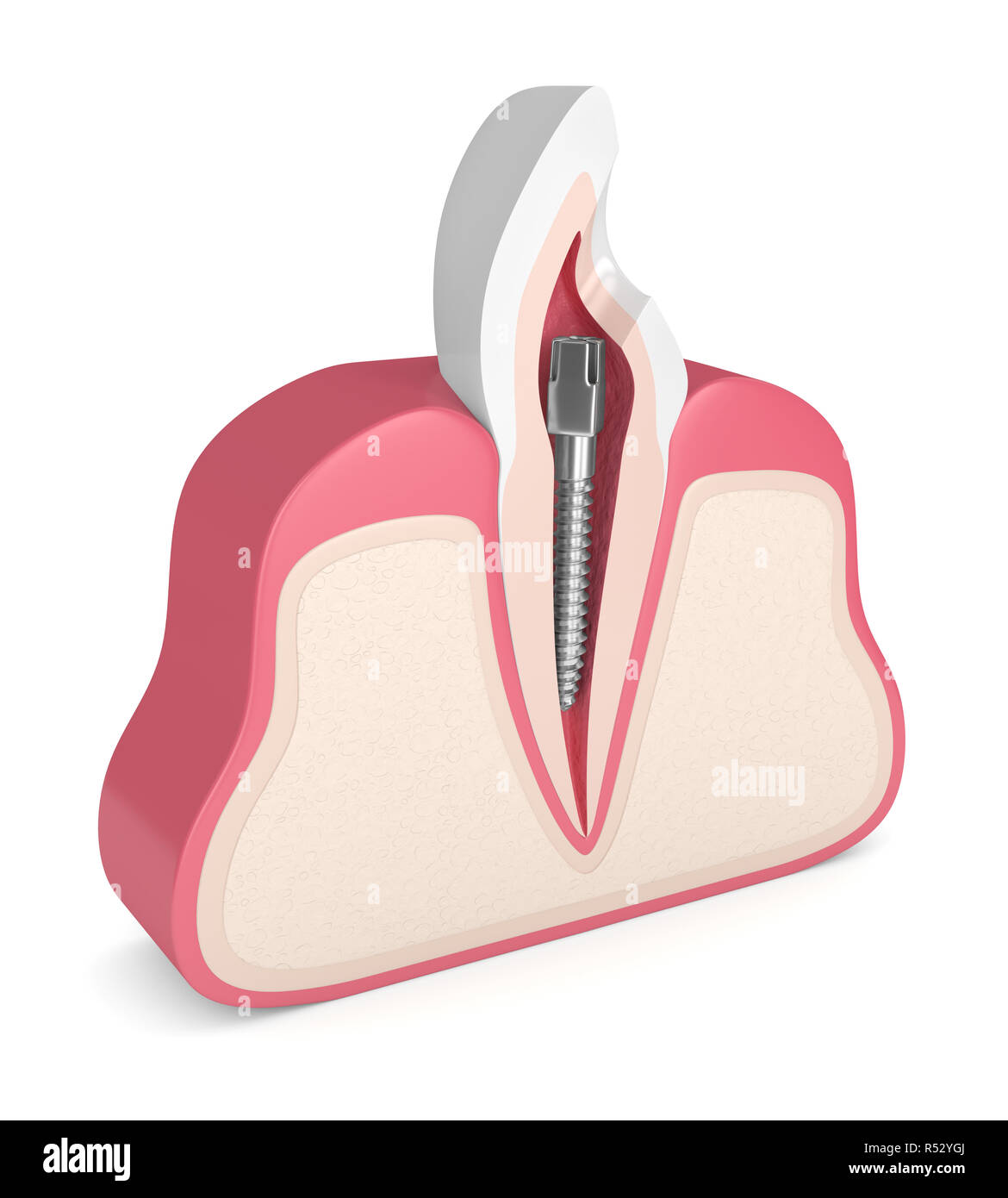 3d render of tooth with dental metal post over white. Endodontic ...