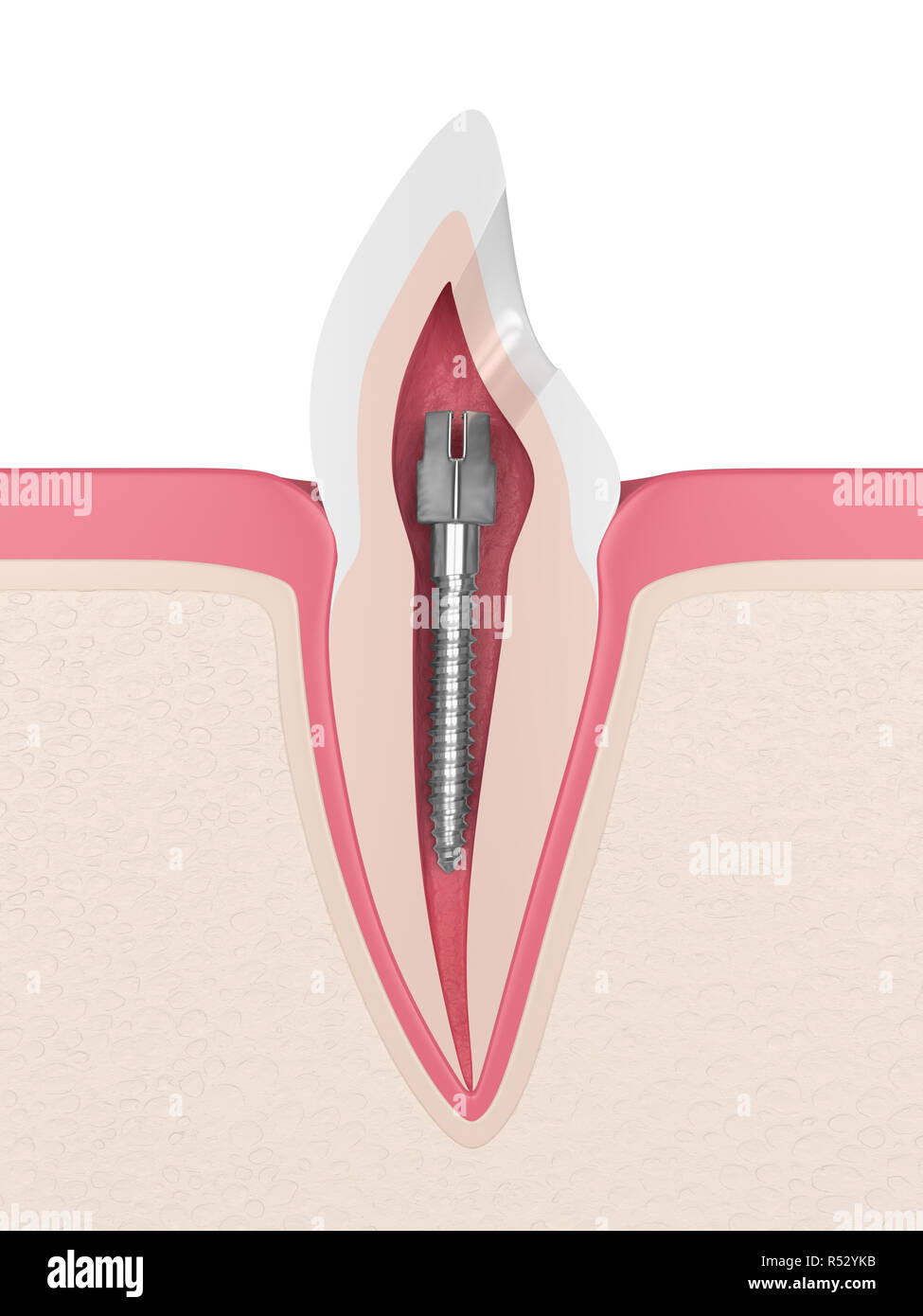 3d render of incisor tooth with dental metal post in gums. Endodontic ...
