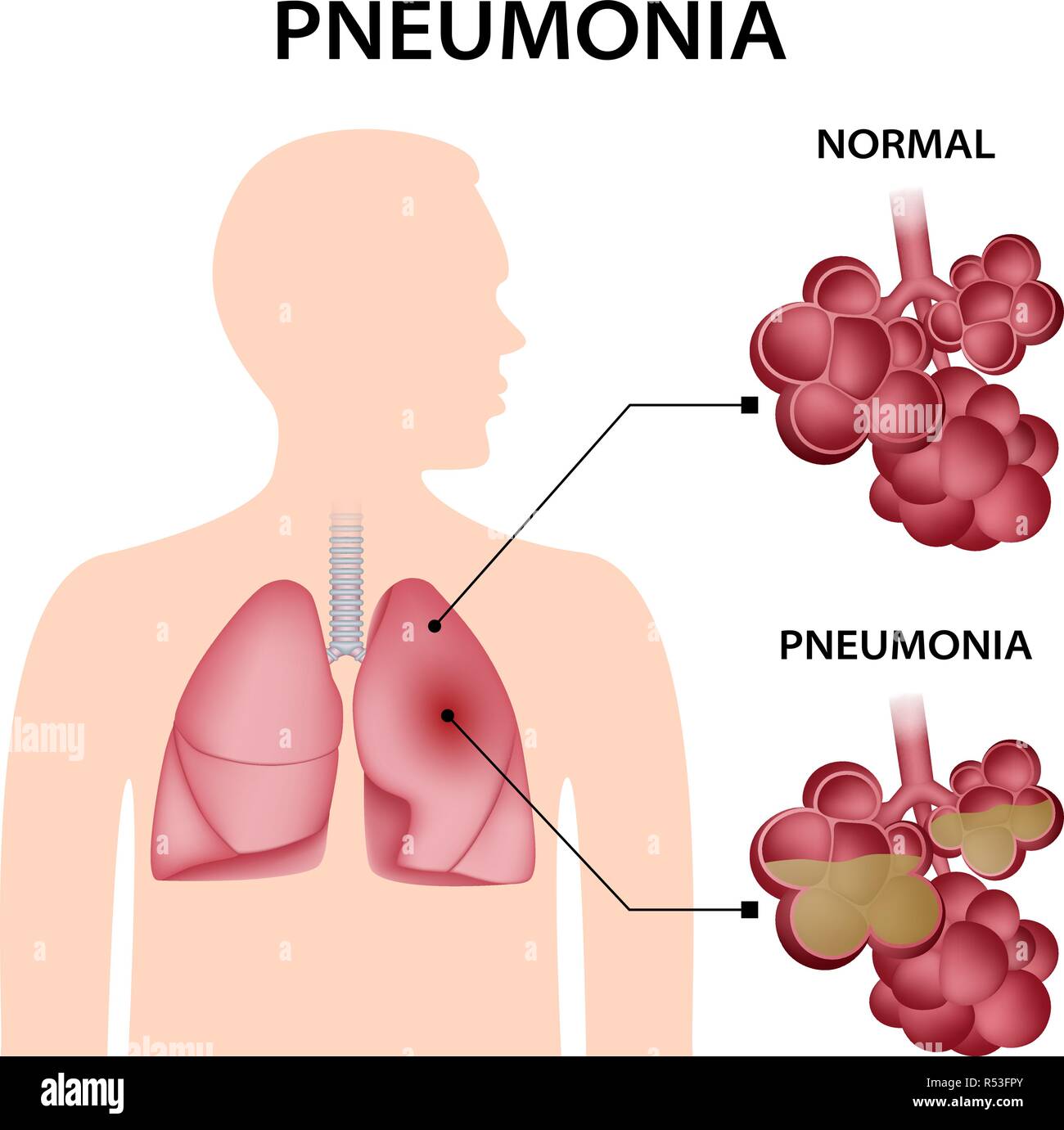 Pneumonia concept background. Realistic illustration of pneumonia ...