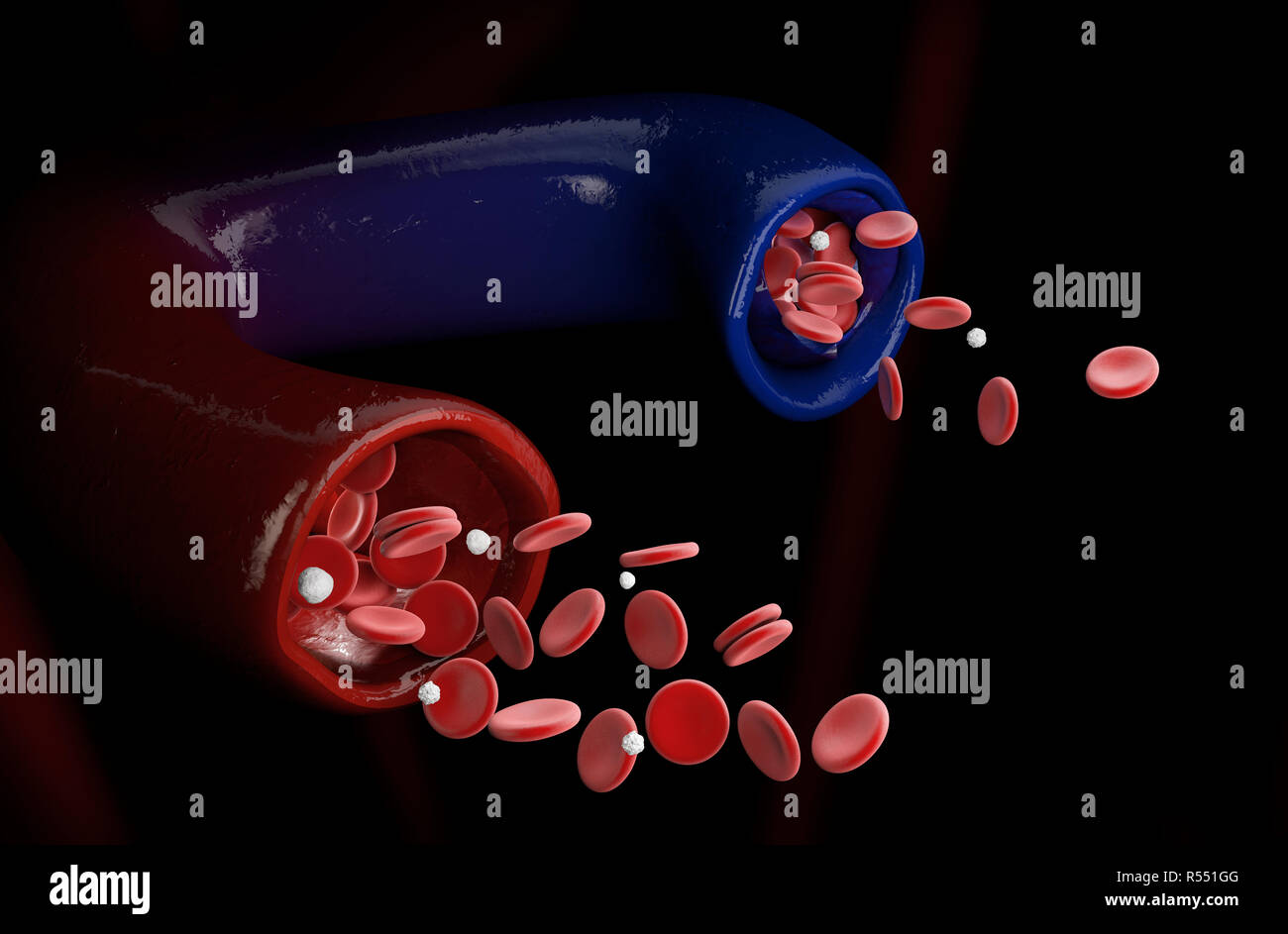 3d Illustration of varicose vein and normal vein, Varicose vein Stock ...