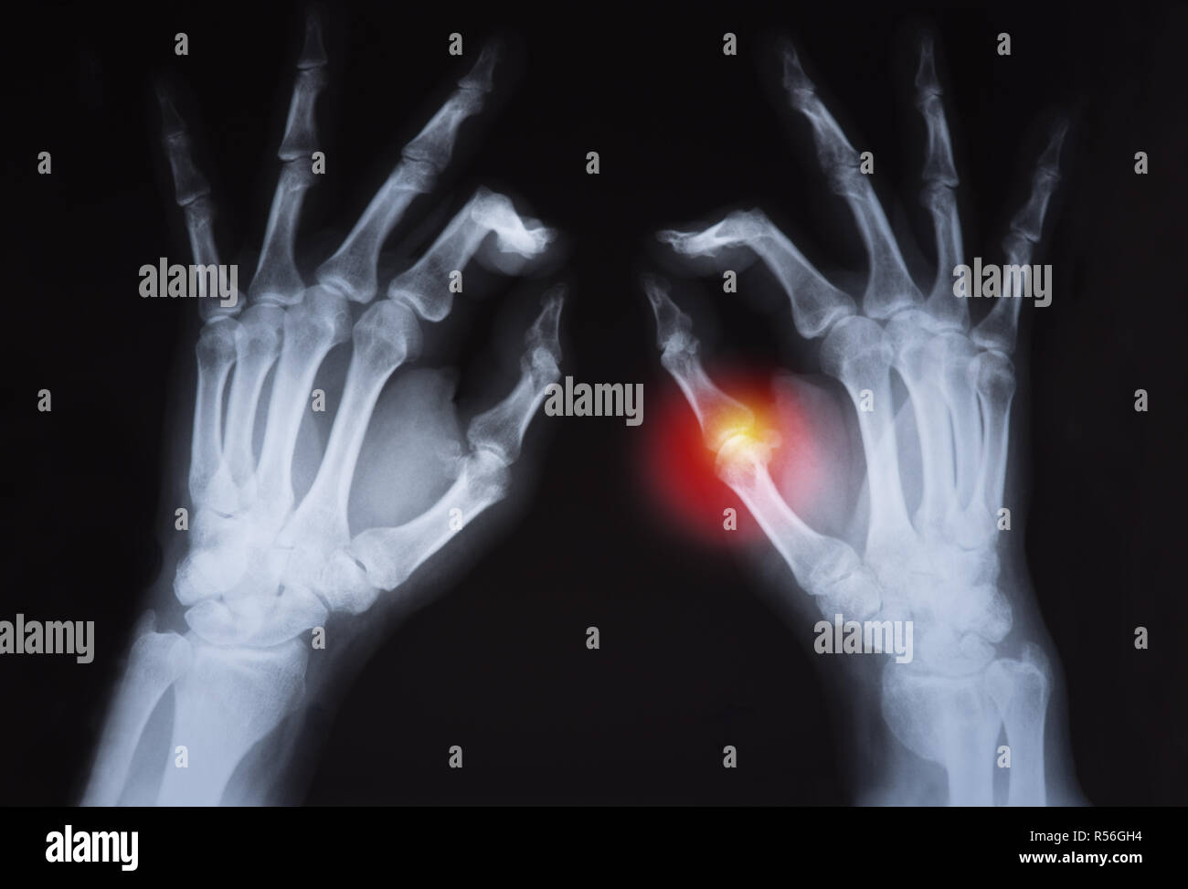 X ray hands arthritis hi-res stock photography and images - Alamy