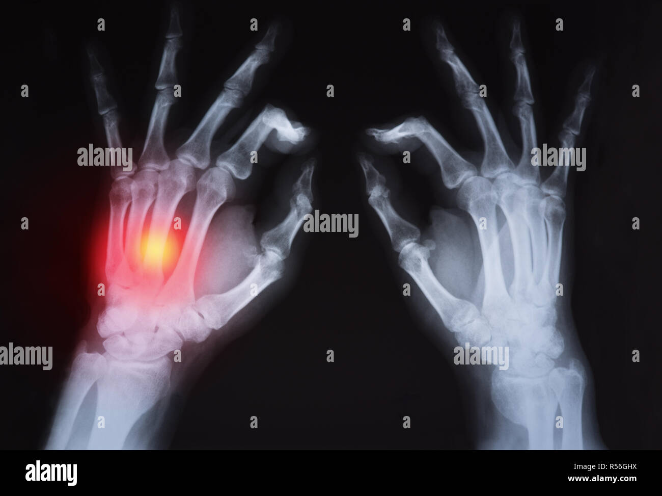 X Ray Hands Rheumatoid Arthritis Stock Photo 120872 Rheumatoid