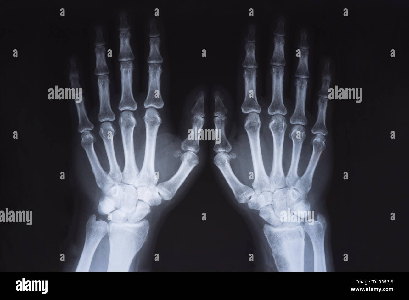X Ray Of Palm High Resolution Stock Photography and Images - Alamy