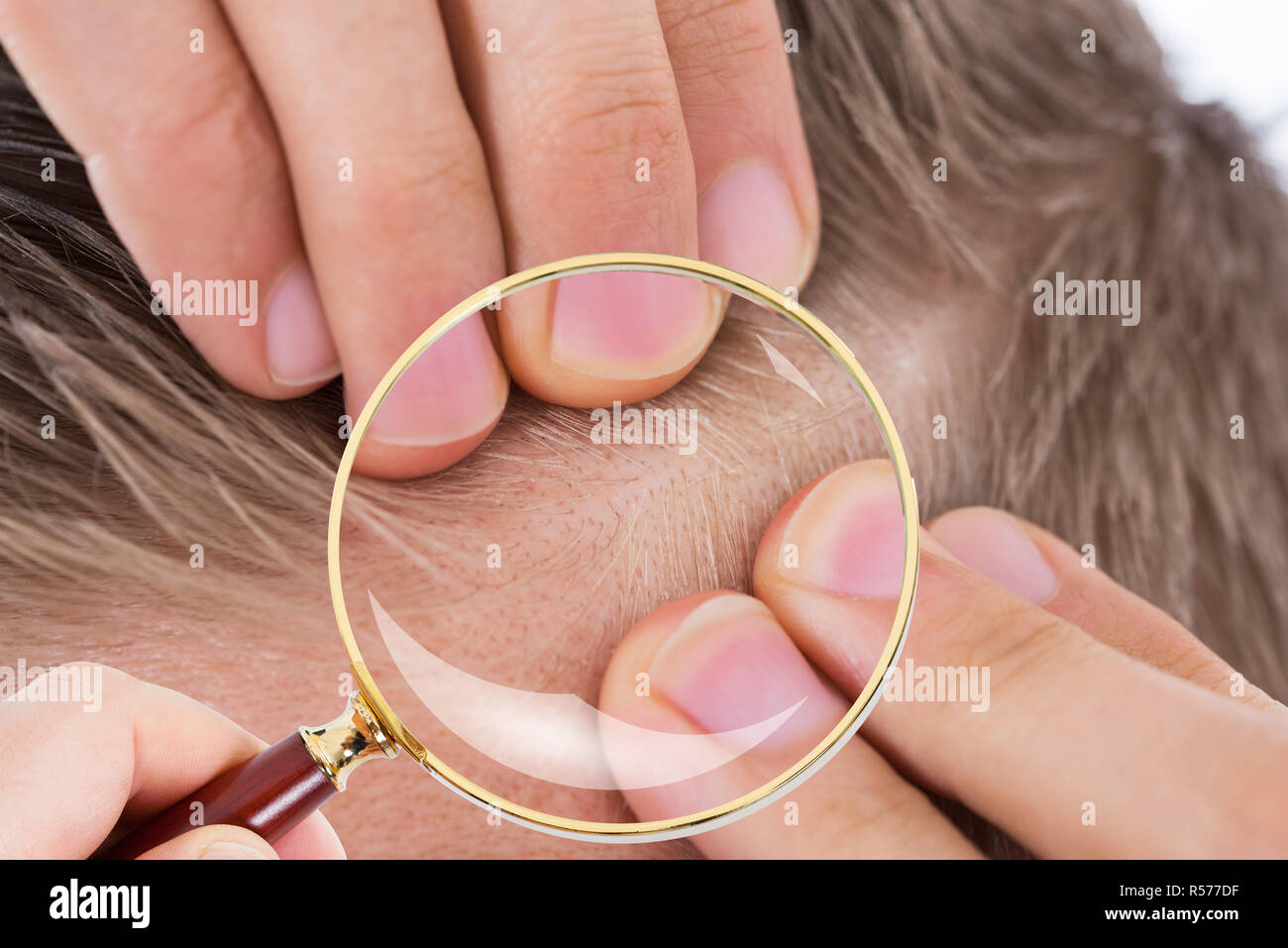 Dermatologist Checking Patient's Hair Stock Photo - Alamy