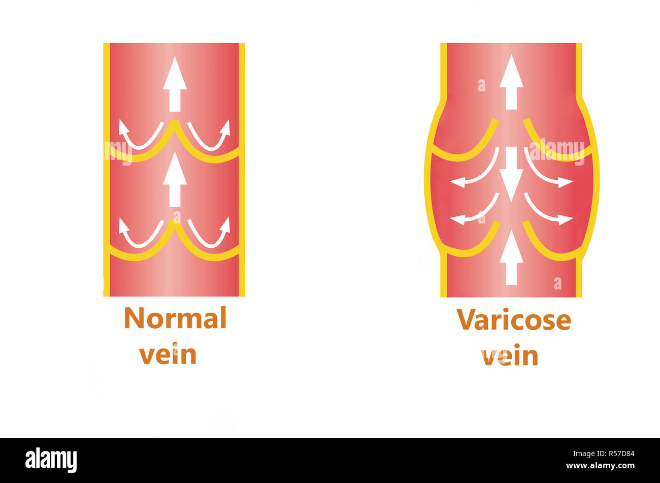 Varicose veins illustration hi-res stock photography and images - Alamy