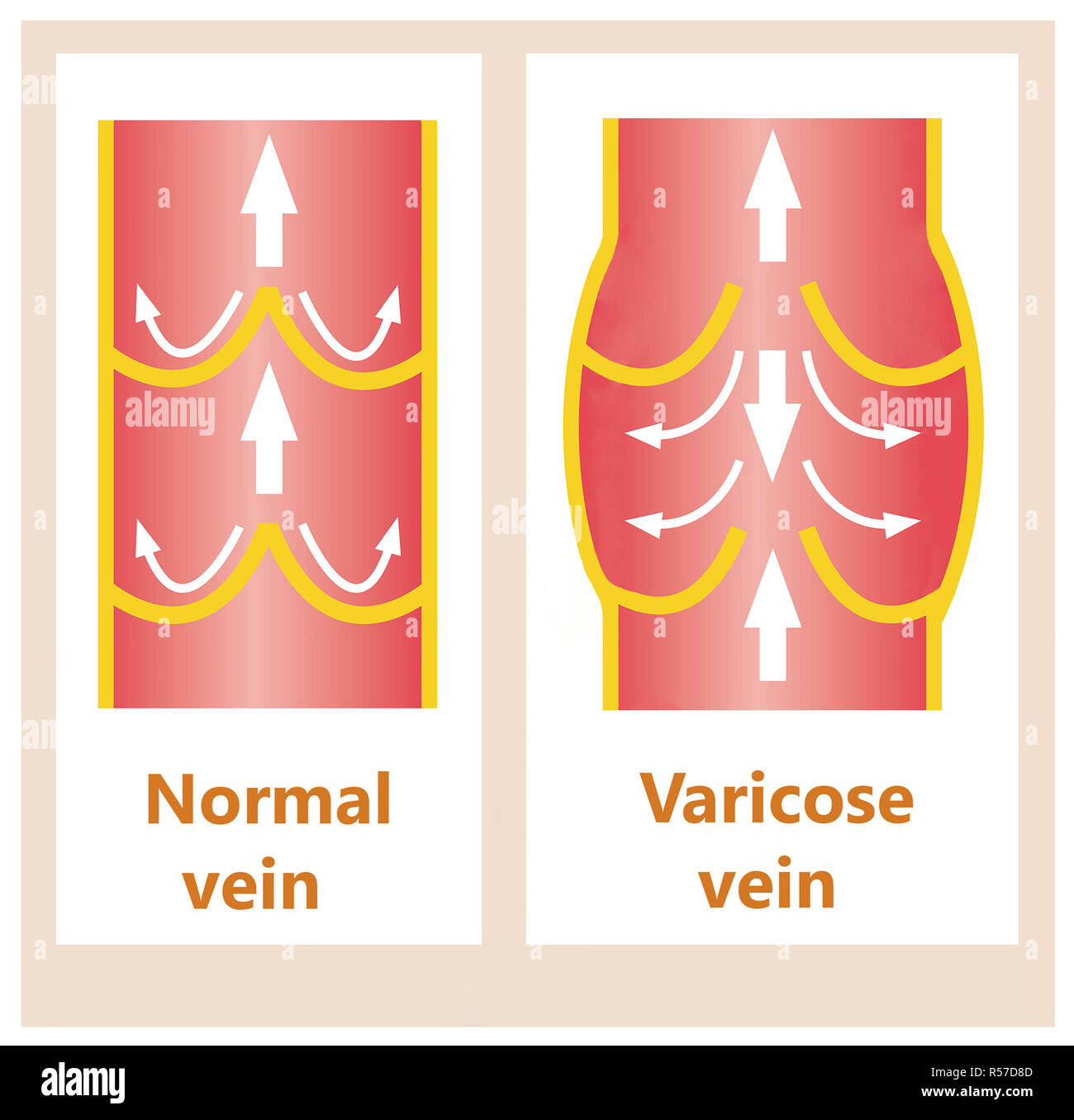 The varicose veins and normal veins Stock Photo - Alamy