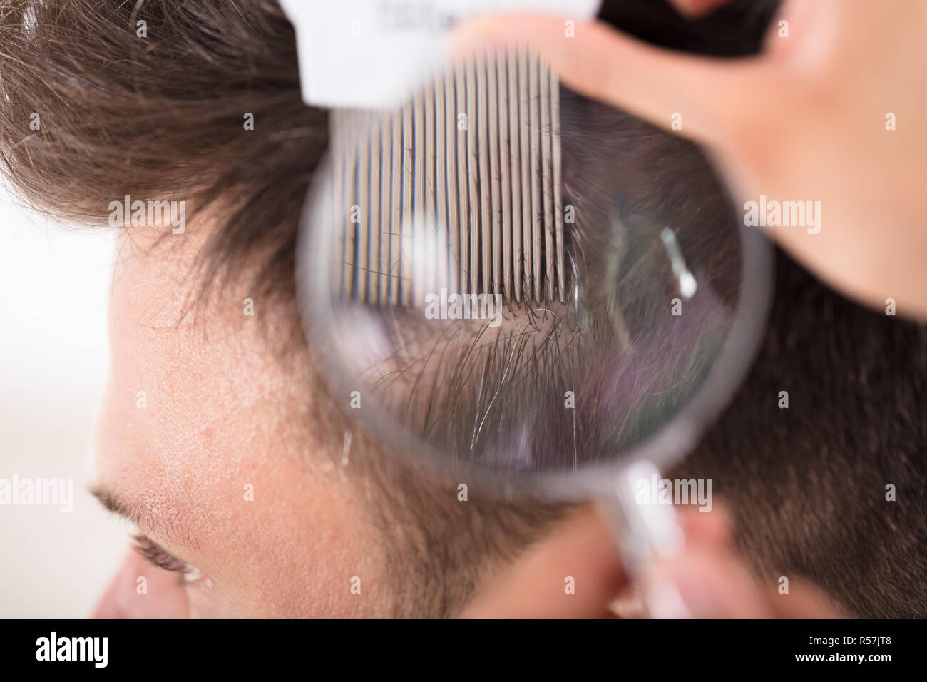 Scalp Psoriasis High Resolution Stock Photography and Images - Alamy