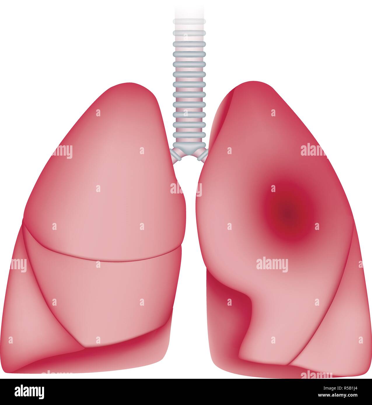 Pneumonia disease lungs icon. Realistic illustration of pneumonia ...