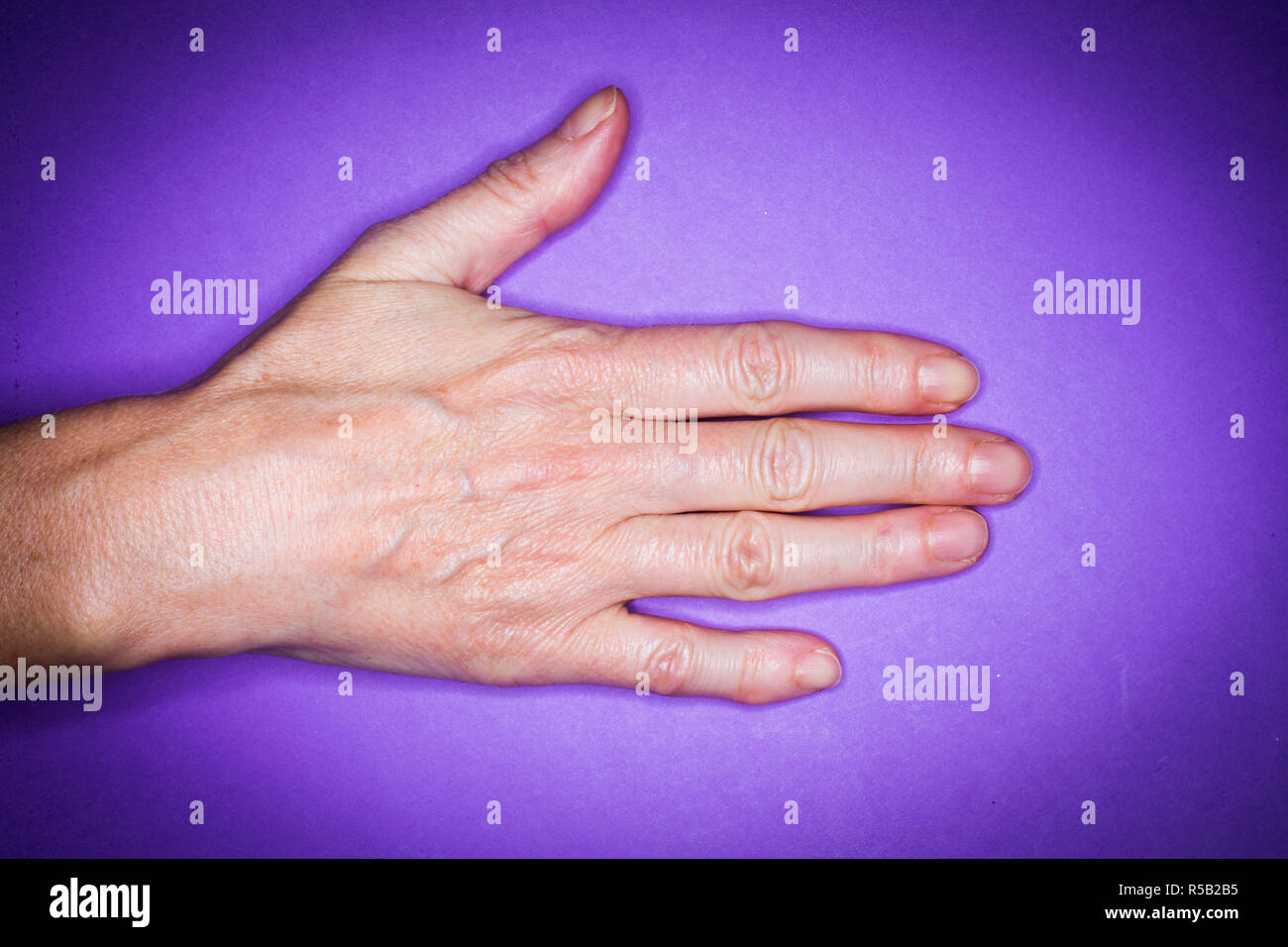 Deformed person hi-res stock photography and images - Alamy
