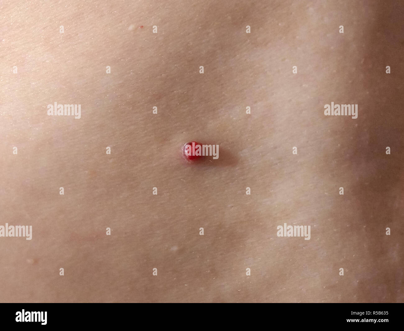 Pyogenic granuloma hi-res stock photography and images - Alamy