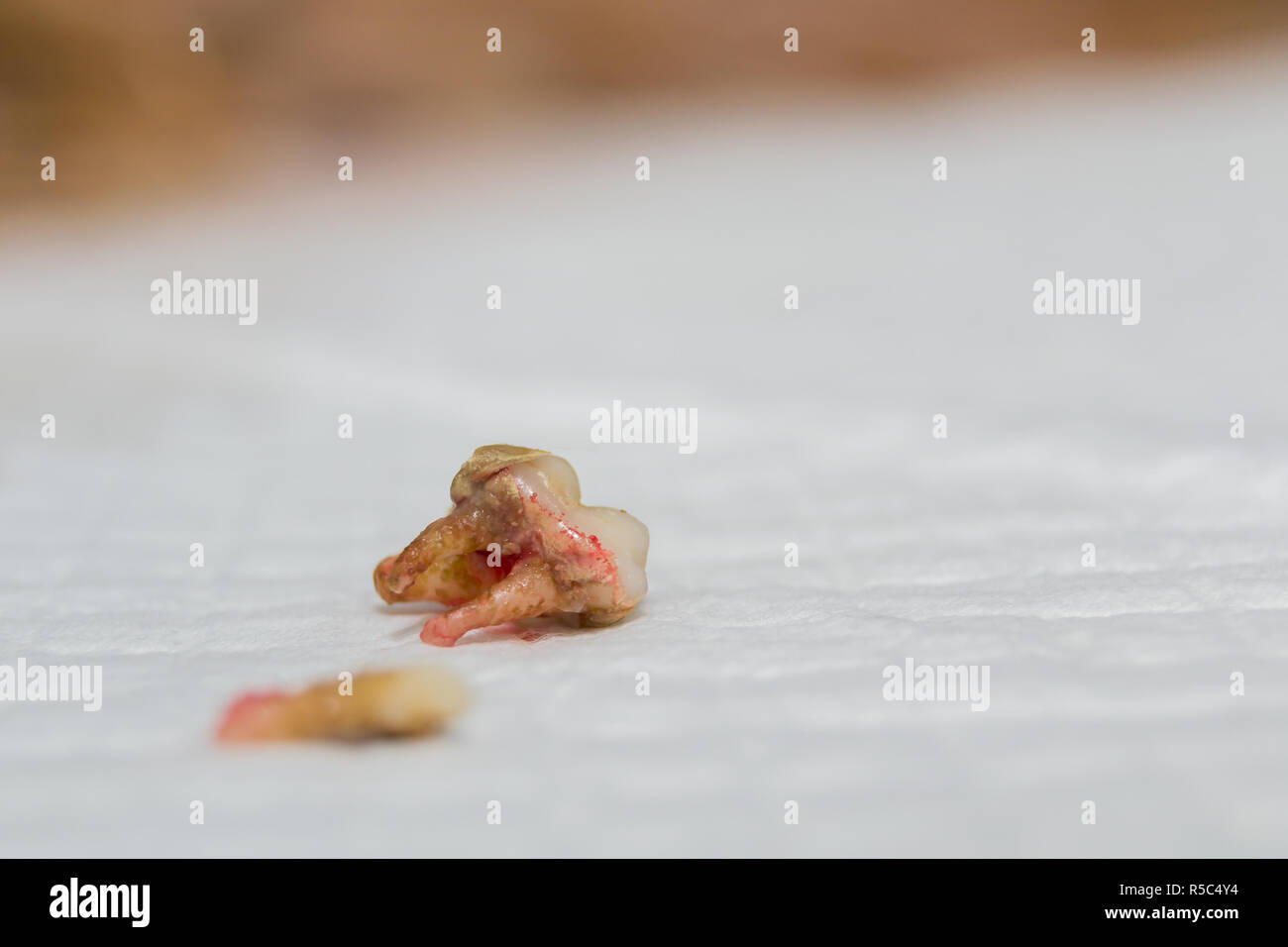 Teeth and tartar hi-res stock photography and images - Alamy