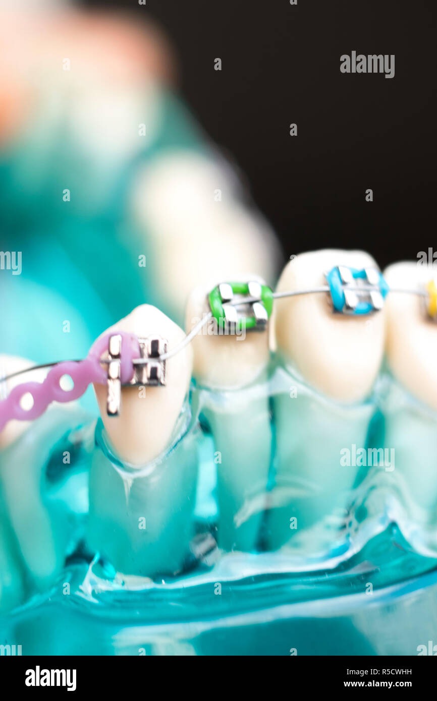 Dental metal braces teeth retainer aligners teaching orthodontics model ...