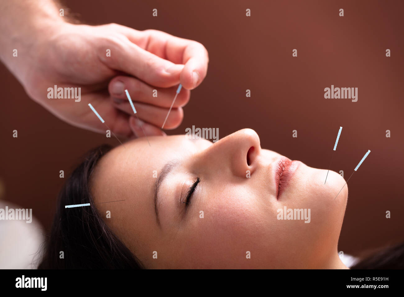 Applying acupuncture on skin hi-res stock photography and images - Alamy