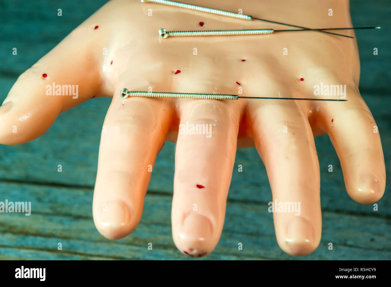 acupuncture needles on hand model Stock Photo - Alamy