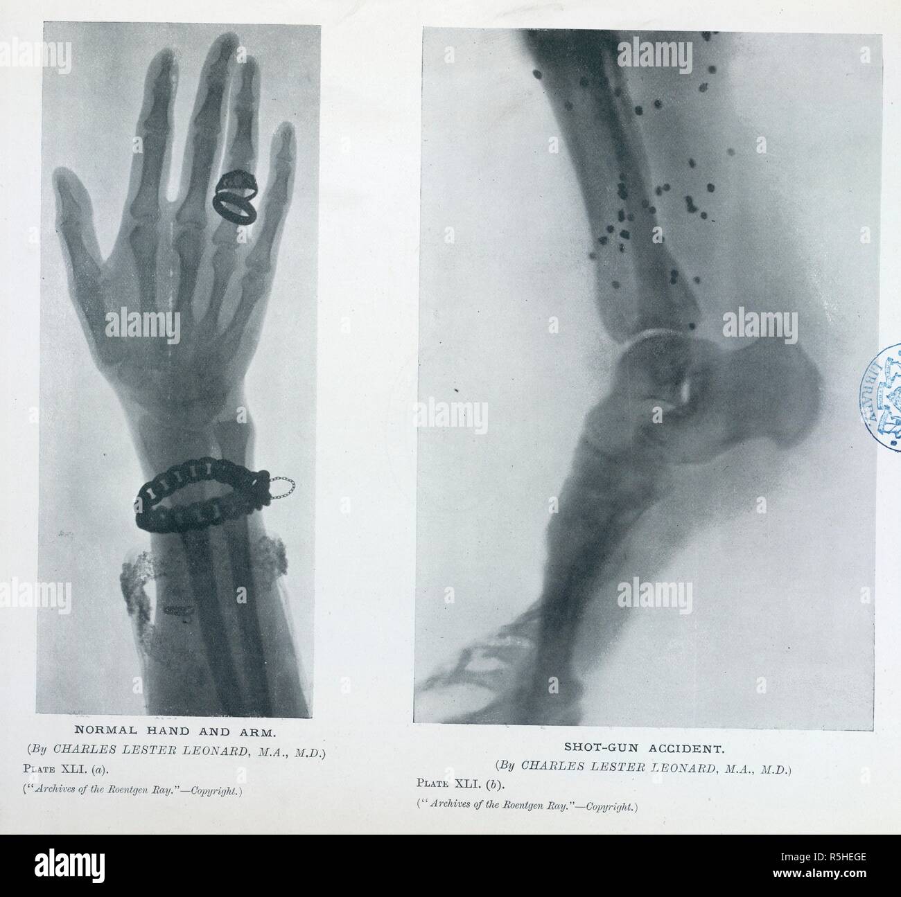 Roentgen hand hi-res stock photography and images - Alamy