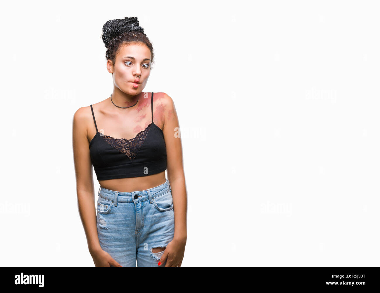 Young braided hair african american with pigmentation blemish birth ...