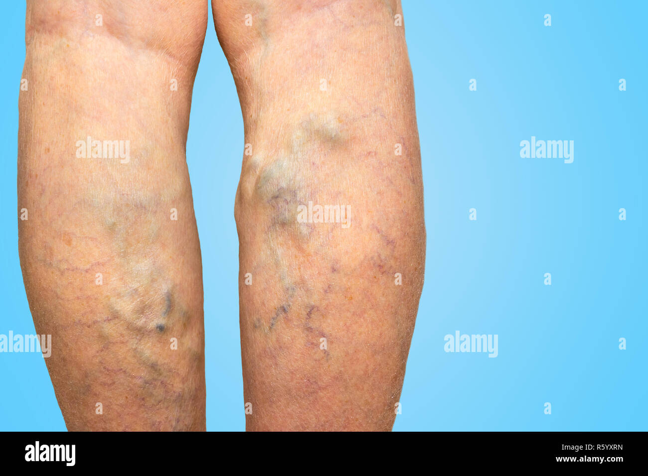 Varicose veins on a female legs Stock Photo - Alamy