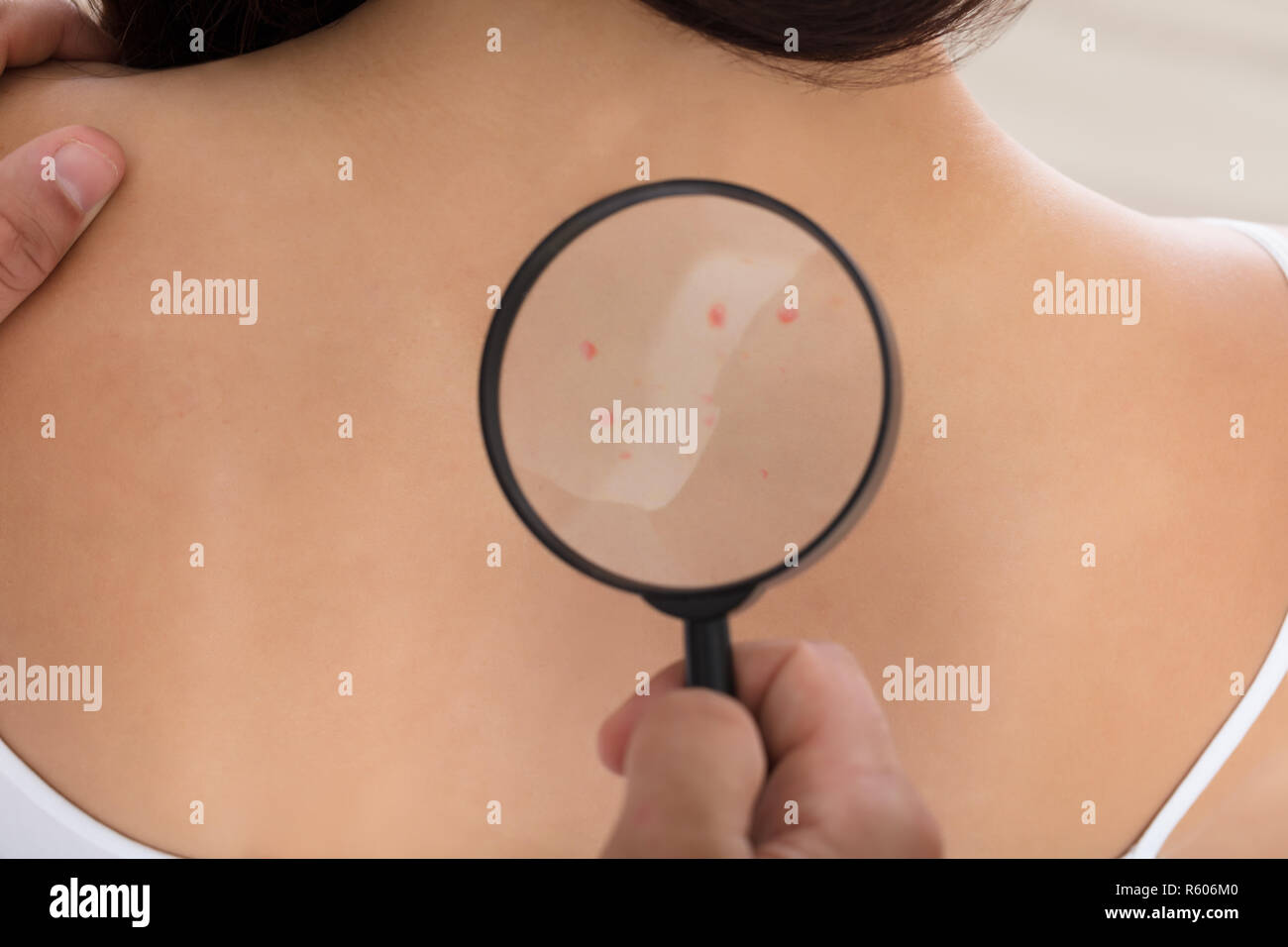 Akne hi-res stock photography and images - Alamy