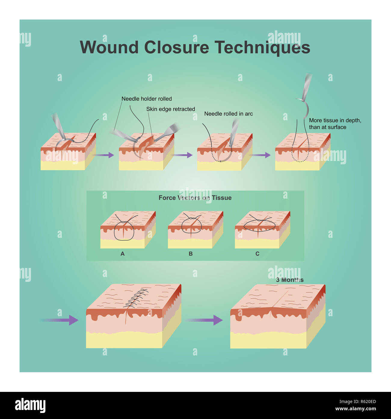 Wound closure hi-res stock photography and images - Alamy