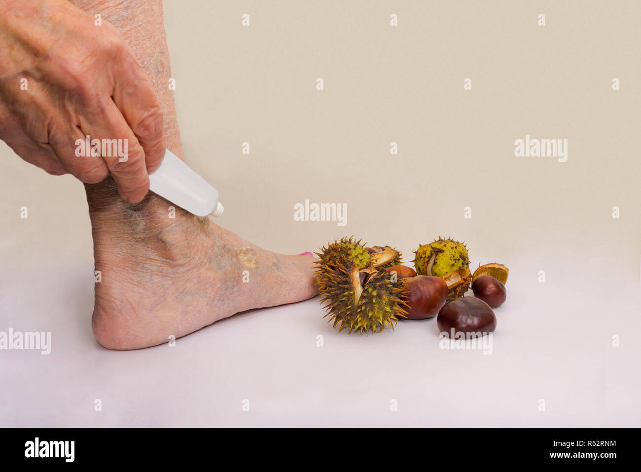 Horse Chestnuts On Legs