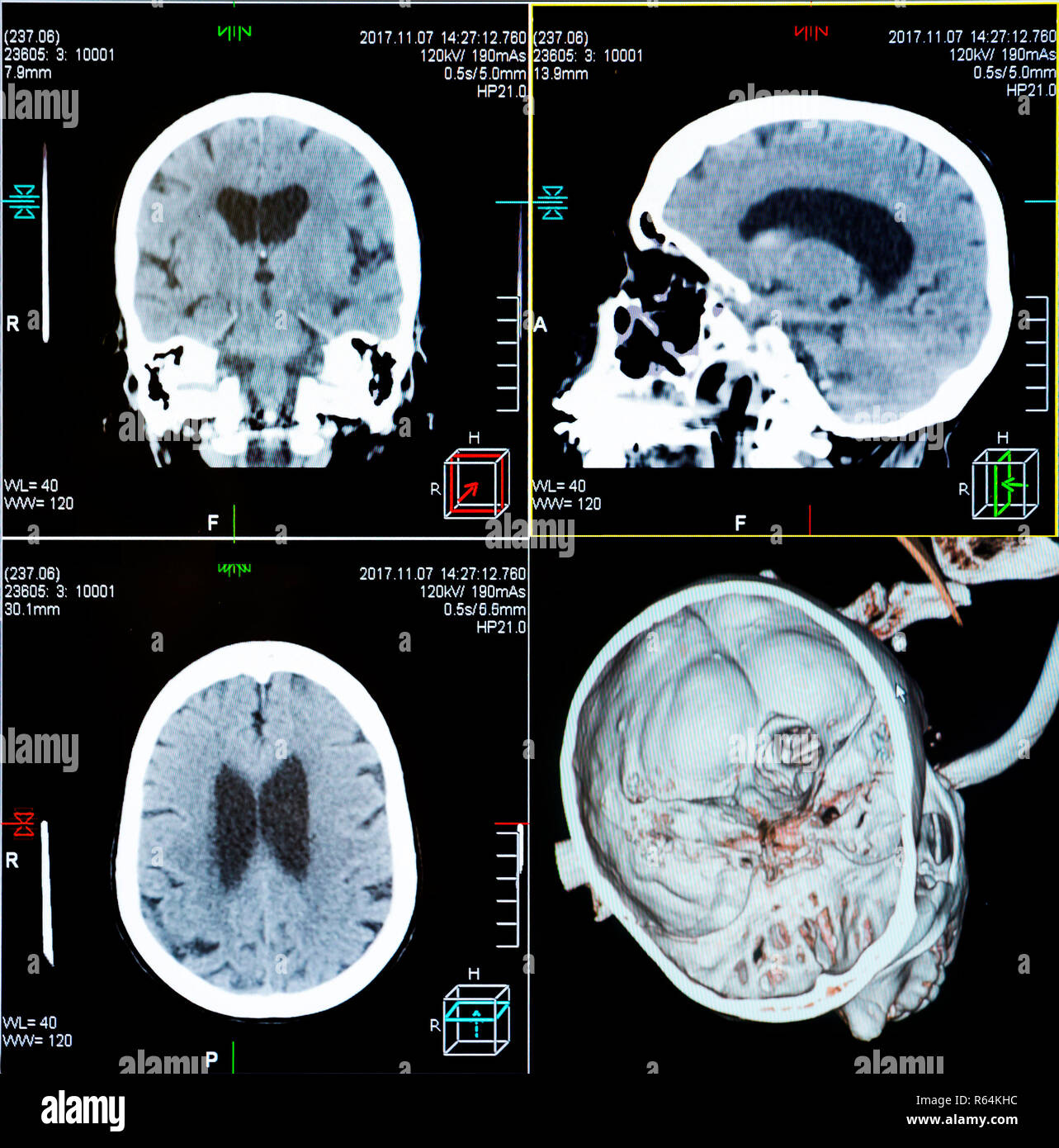Ct Scan Head Injury Stock Photos & Ct Scan Head Injury Stock Images - Alamy Ct Scan Head Injury Stock Photos & Ct Scan Head Injury Stock Images - Alamy