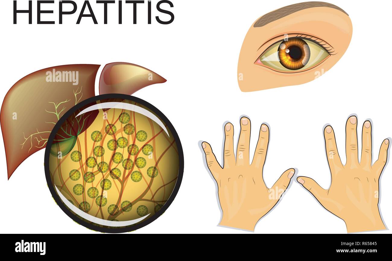 Liver Disease Cells Stock Vector Images - Alamy