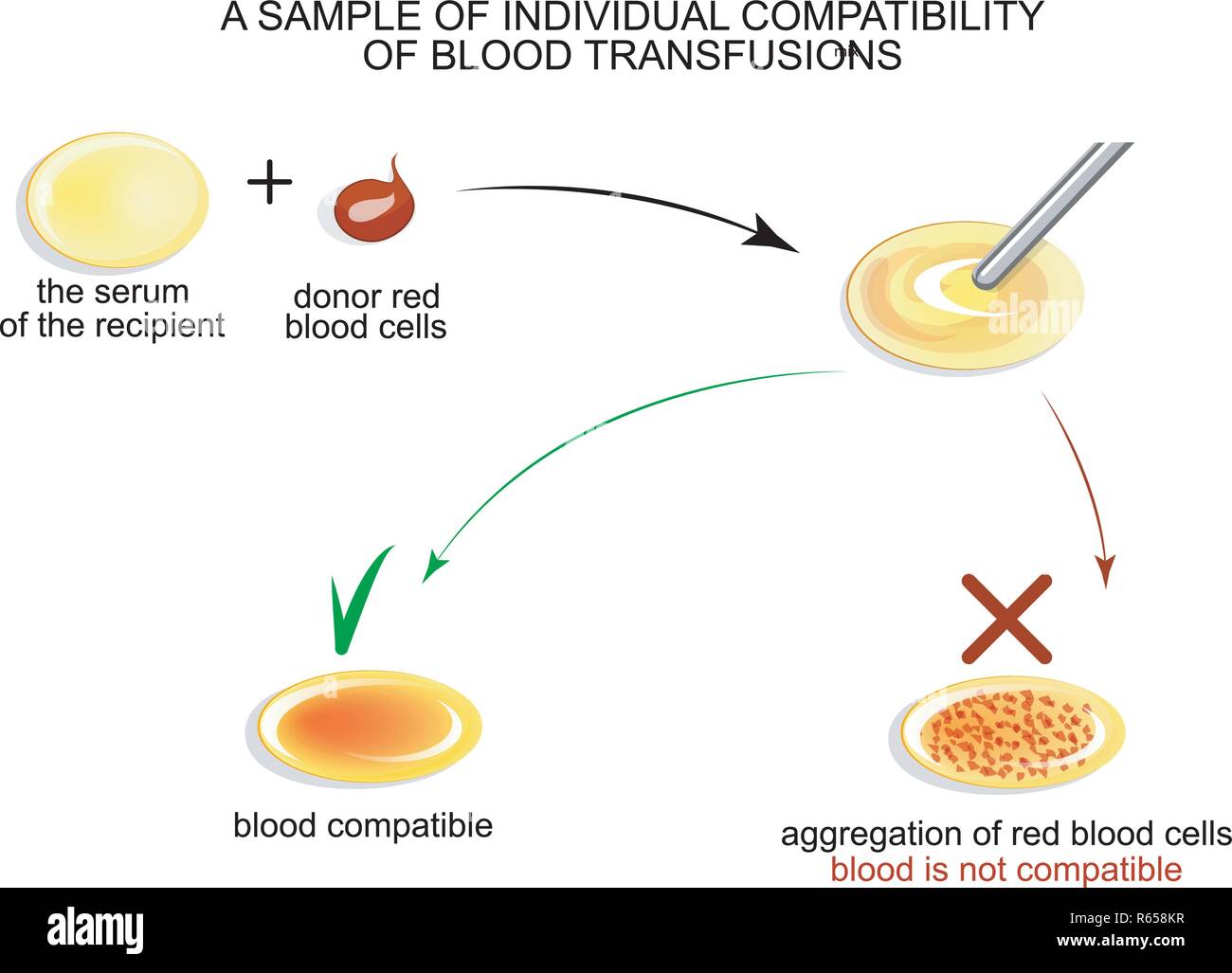 illustration of tests on individual compatibility of blood Stock Vector ...