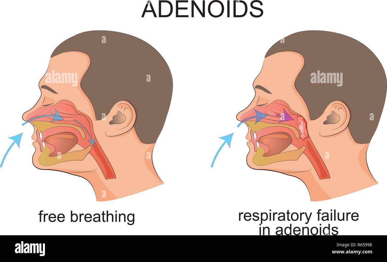 illustration of the growth of adenoids, adenoids, breathing problems ...