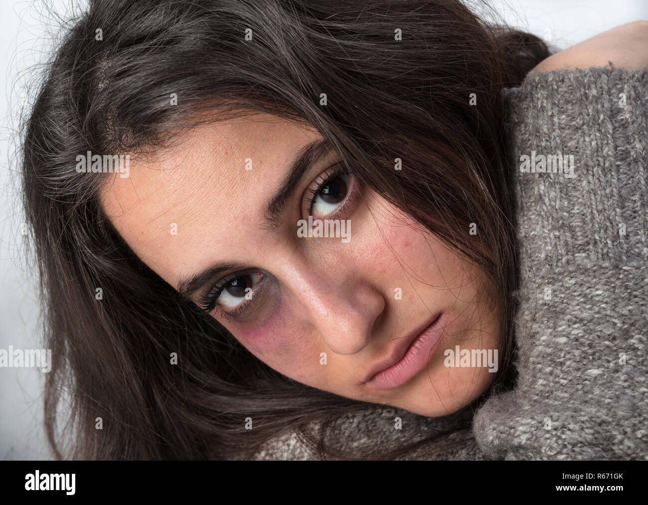 Woman black eye bruise hi-res stock photography and images - Alamy