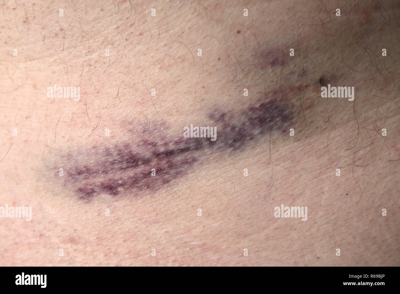 Hematoma hemorrhage hi-res stock photography and images - Alamy