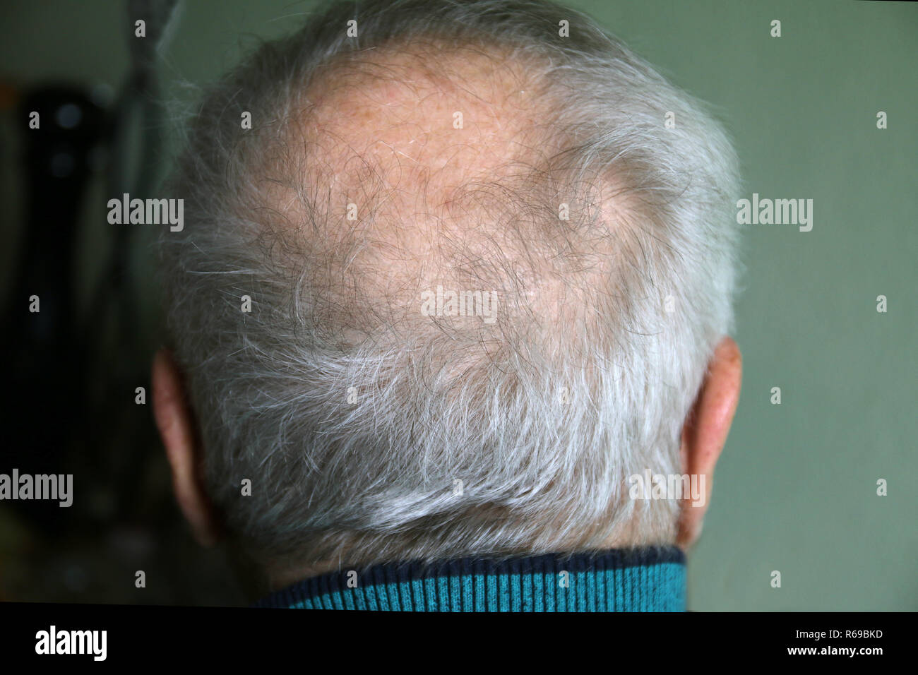 Sparse hair man hi-res stock photography and images - Alamy