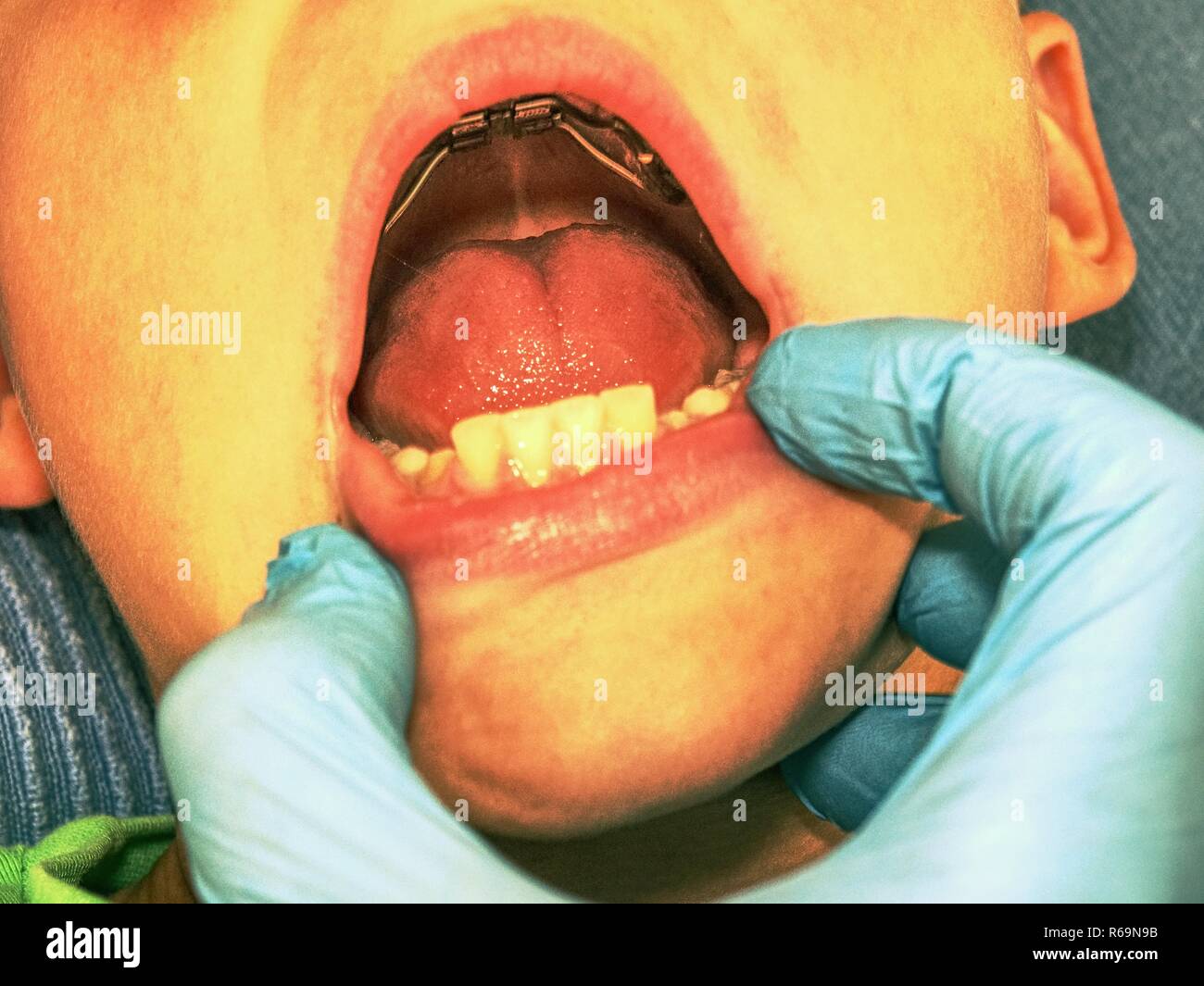 Hyrax palatal expander hi-res stock photography and images - Alamy