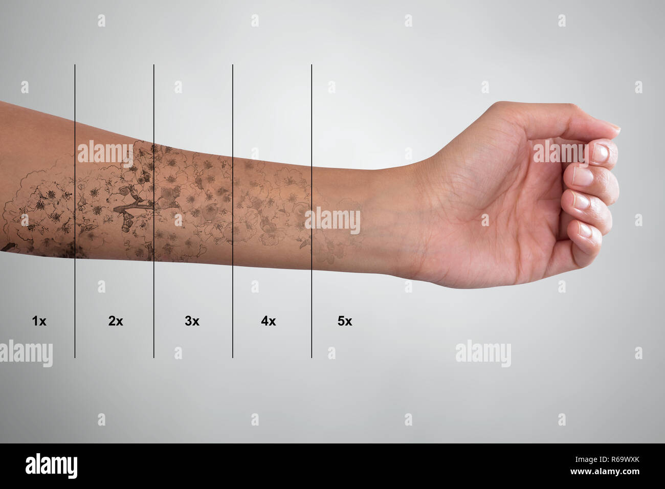 Tattoo Removal On Woman's Hand Stock Photo - Alamy