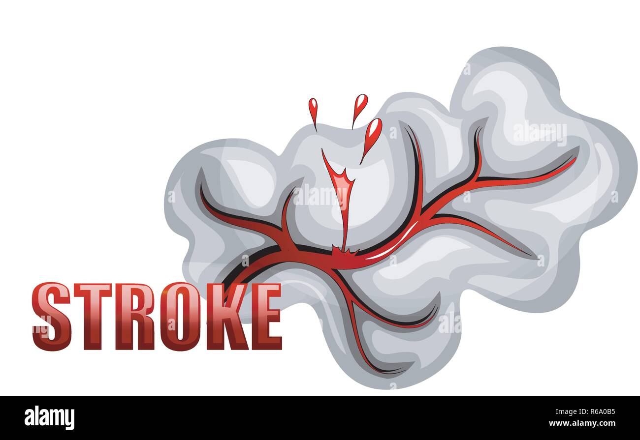 illustration of a rupture of the vessel. hemorrhagic stroke. insult ...