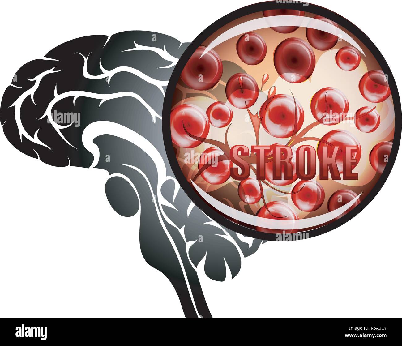 illustration of a rupture of the vessel. hemorrhagic stroke. insult ...