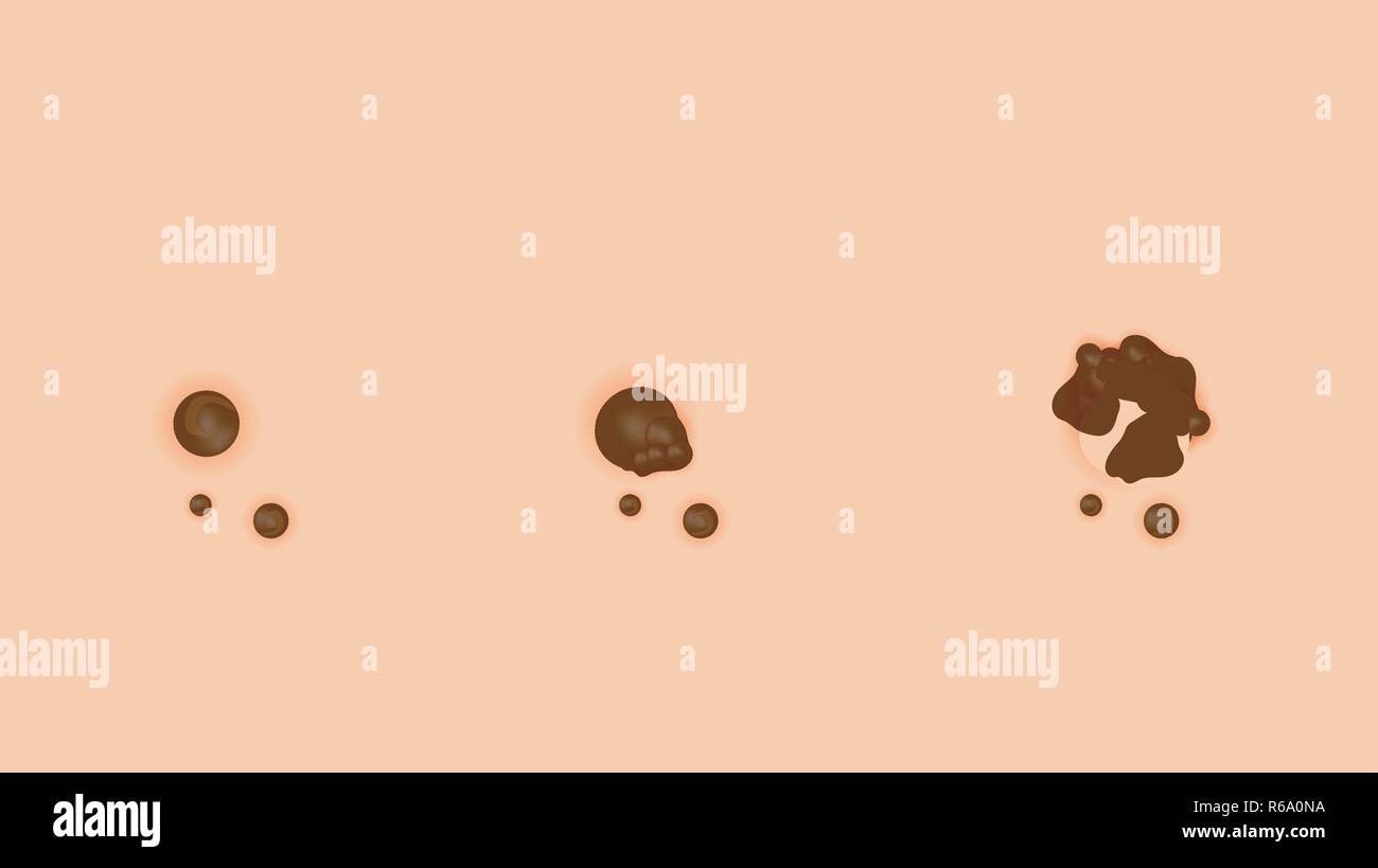 Malignant melanoma stages hi-res stock photography and images - Alamy